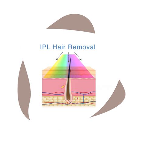Ipl Permanent Hair Removal Vidaskin Medical Aesthetic Clinic
