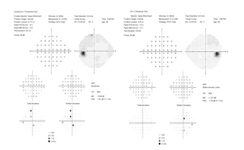 Visual Field Quiz Neuro Ophthalmology