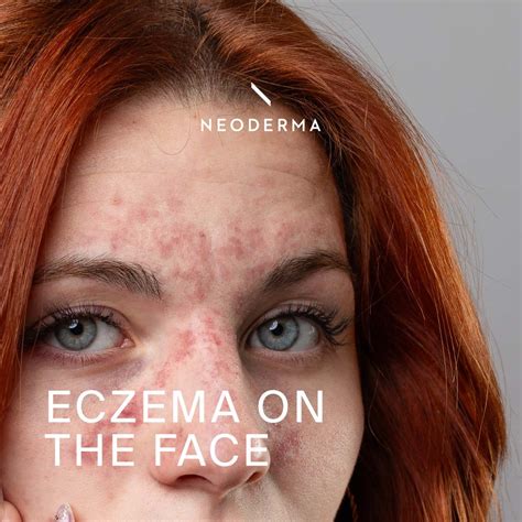 Eczema On The Face And Sensitive Skin Care Products Neoderma