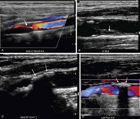Ultrasound Evaluation Of The Carotid Arteries Radiology Key