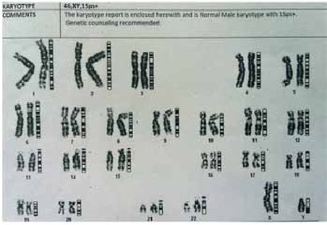 Abnormal Karyotype 46xy 15ps Download Scientific Diagram