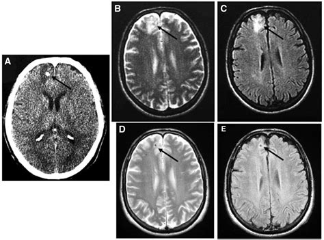 Toxoplasmosis Brain