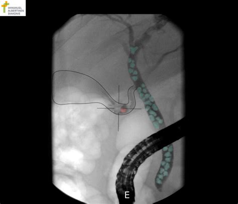 Choledocholithiasis Ercp
