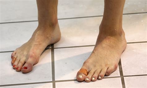 A Fungus That Causes Athletes Foot May Be Cloning Itself Newsweek