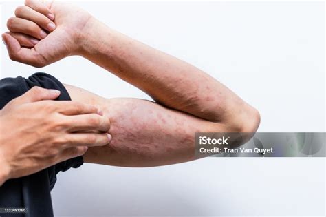 Close Up Dermatitis Pada Tangan Manusia Alergi Ruam Dermatitis Kulit