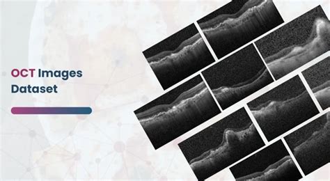 Oct Images Dataset For Retinal Disease Detection And Ai Research
