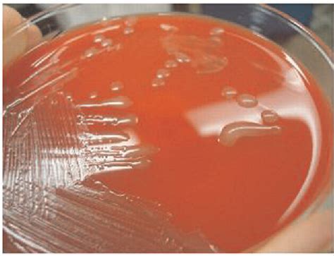 Figure 1 From An Update On Cryptococcus Among Hiv Infected Patients Semantic Scholar