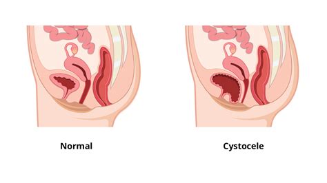 Cystocele Wellspect