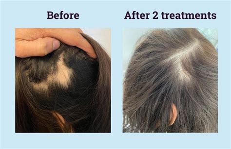 Steroid Injections For Hair Loss Fact Sheet And Definitive Guide