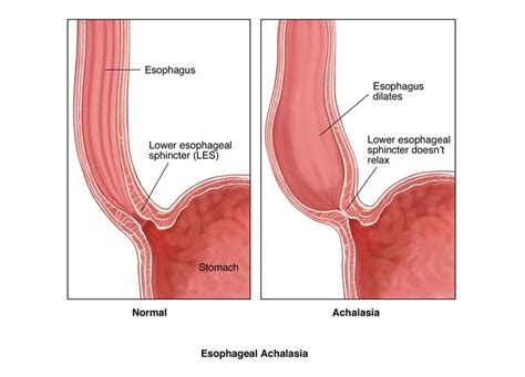 Esophageal Dilation Procedure Benefits And Recovery News Usa Today