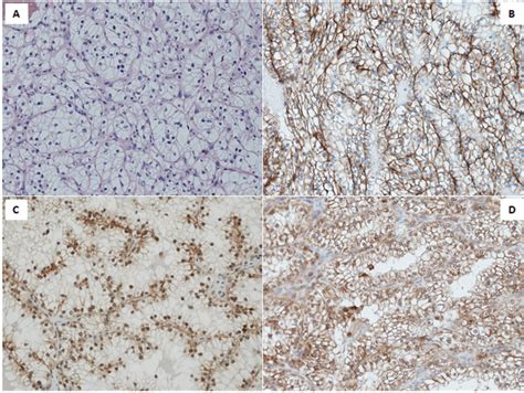 Morphologic And Immunohistochemical Features Of Clear Cell Renal Cell