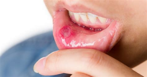 What Is Oral Thrush The Causes Symptoms And Risks