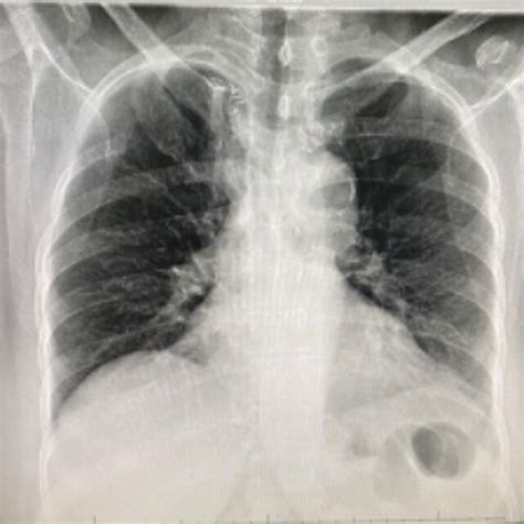 Normal Chest X Ray 3 Months After Surgical Resection Download