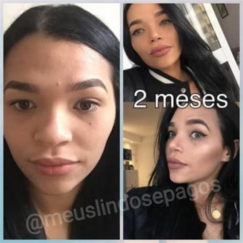 Meus Lindos E Pagos Rinoplastia Aberta