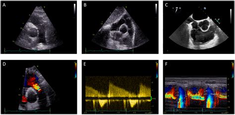 Allina Echocardiogram At Jerome Cairns Blog