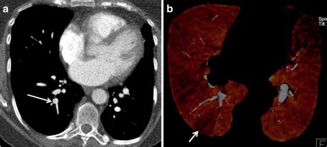 Chronic Thromboembolic Disease A Dual Energy Ct Shows A Thin Download Scientific Diagram