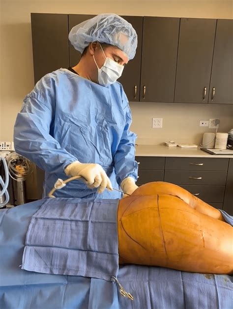 10 Key Things To Know Before Your Buttock Augmentation Consultation