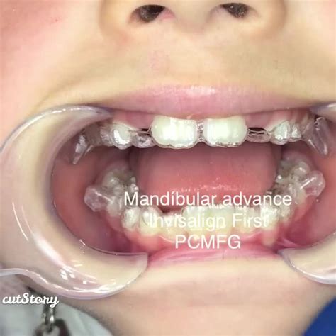 Pedro Costa Monteiro On Linkedin Invisalign First For Class Ii