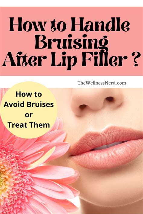 How To Tackle Bruising After Lip Or Dermal Fillers Lip Fillers Dermal Fillers Lips Dermal