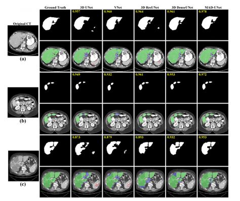 Multi Scale Attention And Deep Supervision Based 3d Unet For Automatic Liver Segmentation From Ct