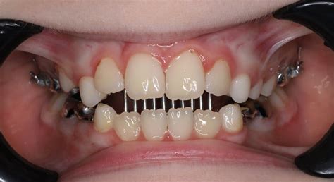 Open Bite Treatment Using Maxillary Expansion сases Of The Polar Bear