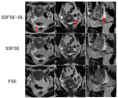 Ovarian Mri In A 16 Year Old Adolescent Girl With Confirmed Pcos
