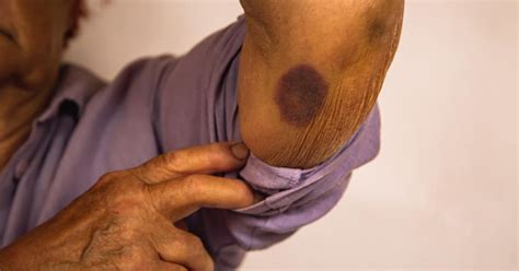 How To Treat Bruising In The Elderly Suresafe