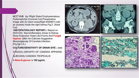 Ppt Emphysematous Pyelonephritis Due To Fungal Cause Pptx