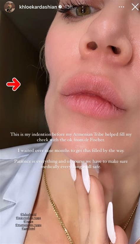 Khloe Kardashian Opens Up About Cheek Indentation Left By Her Melanoma