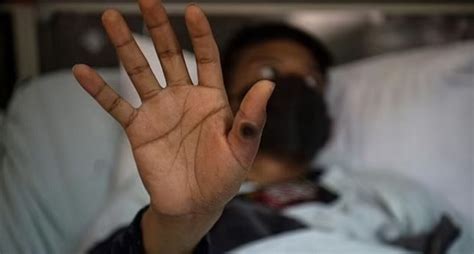 آبله میمونی یک تهدید جدی است اهمیت اقدامات پیشگیرانه خبرگزاری مهر