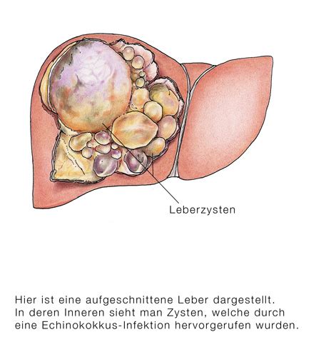 Echinococcus Multilocularis Zyste