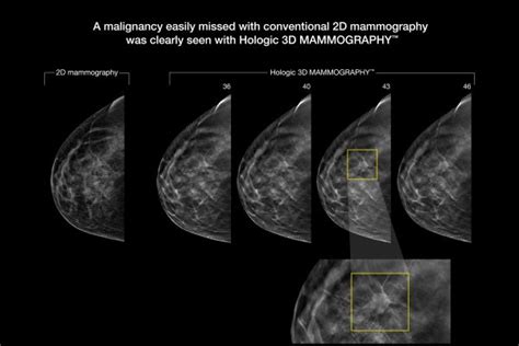 Abnormal Mammogram