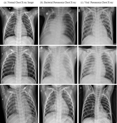 Chest X Ray Images From Kaggle Dataset A Normal Lung Image B