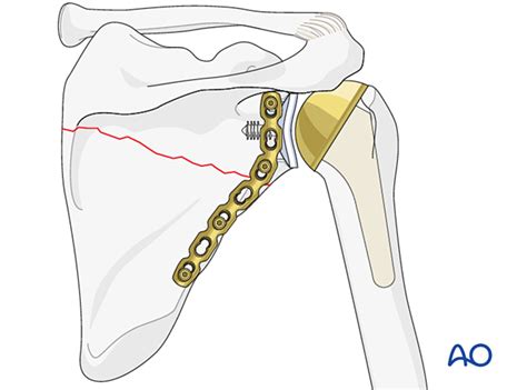 Orif Plate Fixation For Body Of The Scapula