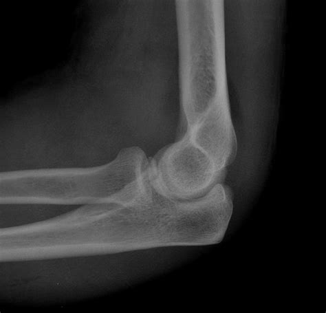 bone fracture detection object detection dataset by bonefracture