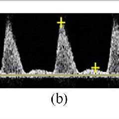 A Triphasic B Biphasic And C Monophasic Doppler Waveforms