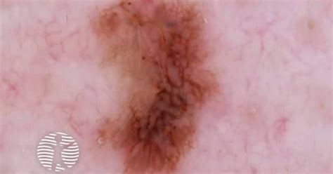 Dermatoscopy Of Dysplastic Naevus Image