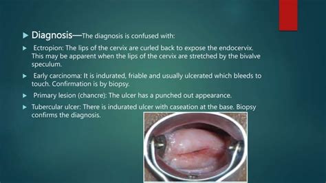 Cervical Ectopy Or Cervical Erosion Pptx
