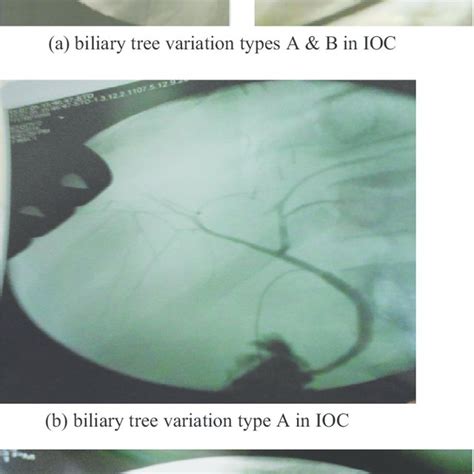 Biliary Tree Variation Types D1 And D2 In Ioc Download Scientific