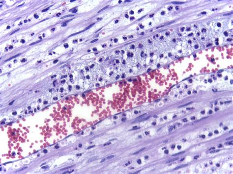 Acute Inflammation Features Exudate Teachmephysiology