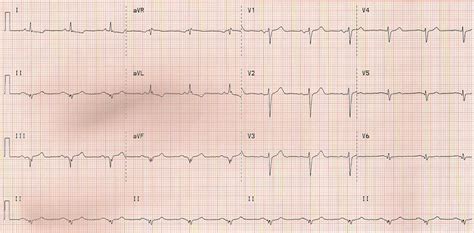 Interatrial Block Ecg