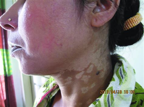 Pkdl From Bangladesh Confluent Macular Rash Involving Most Of The Face