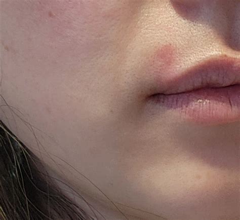 피부에 빨간 증상 지식in