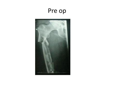 Comminuted Segmental Fracture Of Femur Shaft Ppt