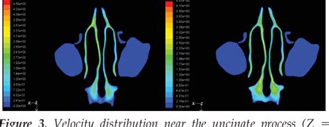Figure 1 From Computational Fluid Dynamics Simulation Of Airflow In The Normal Nasal Cavity And