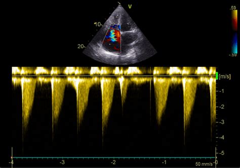 Continuous Wave Cw Doppler Of Tricuspid Regurgitation From The Download Scientific Diagram
