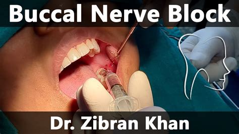 Inferior Alveolar Nerve Block Step By Step • Video • 47 Off