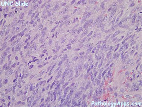 Synovial Sarcoma Pathology