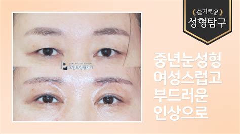눈썹밑절개거상수술 눈썹하거상수술 수술전후사진 Youtube