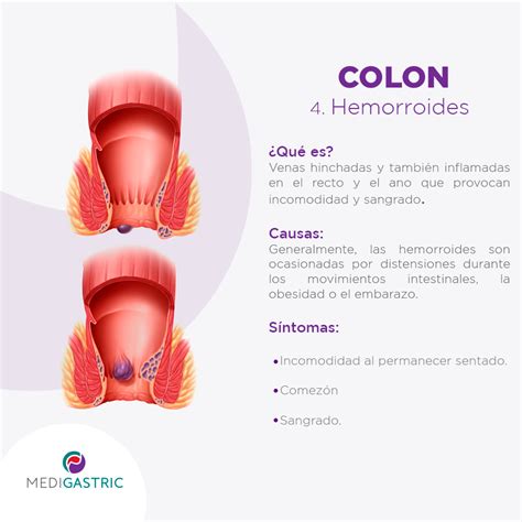 Hemorroides Internas Sintomas